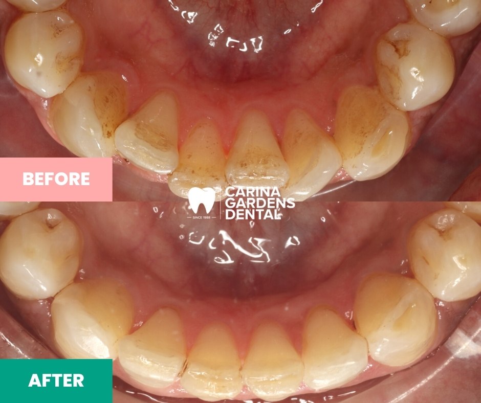 Smile Gallery Brisbane | Before & After Dental Treatments