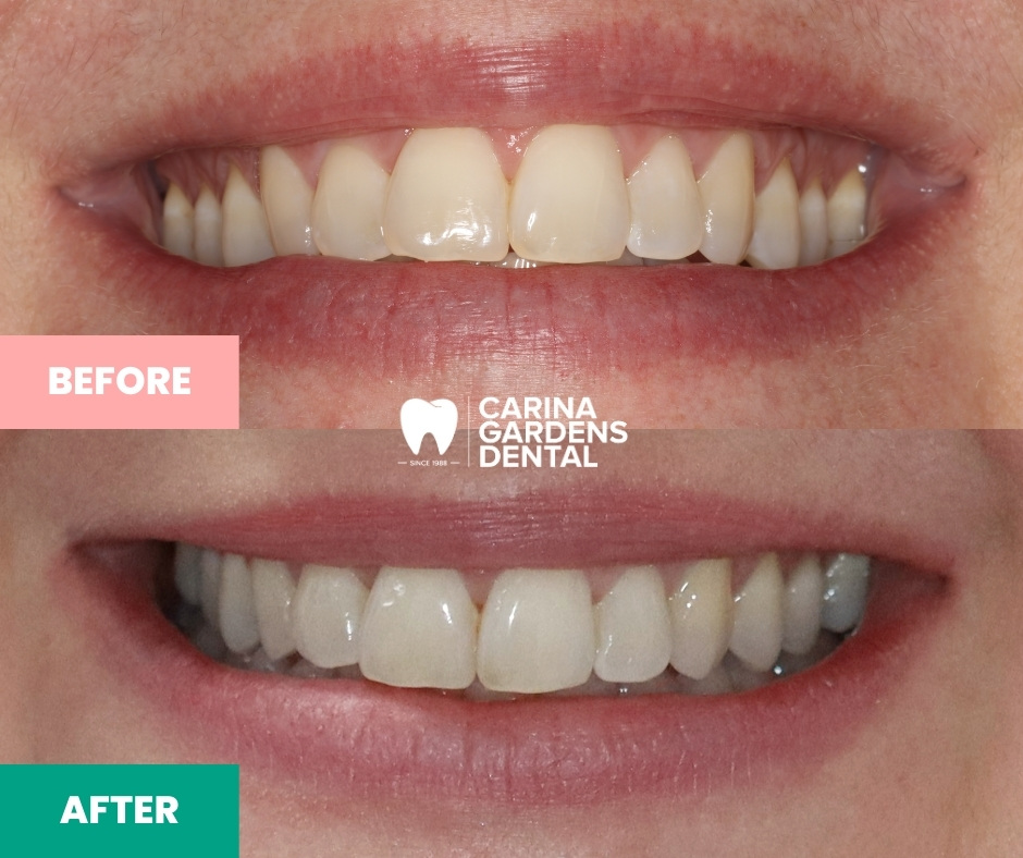 Smile Gallery Brisbane | Before & After Dental Treatments