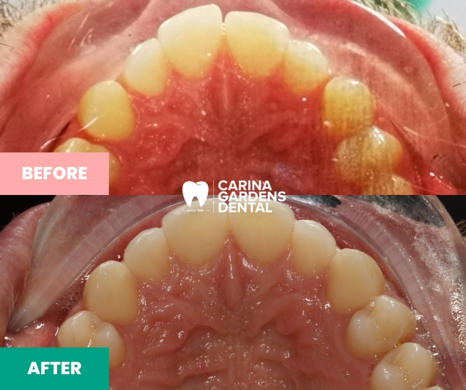 Smile Gallery Brisbane | Before & After Dental Treatments